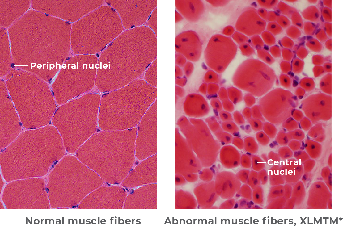 Like other CNMs, XLMTM is characterized by large, central nuclei of the ...